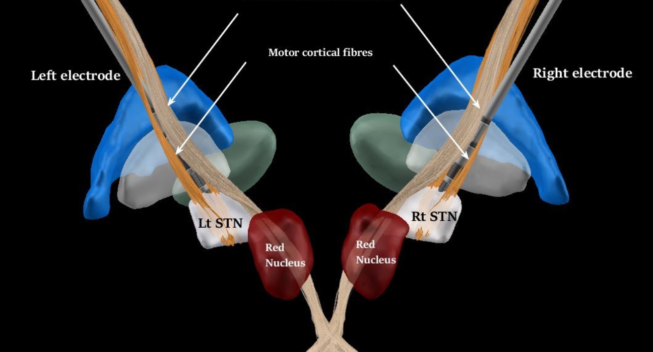 Components Of DBS System