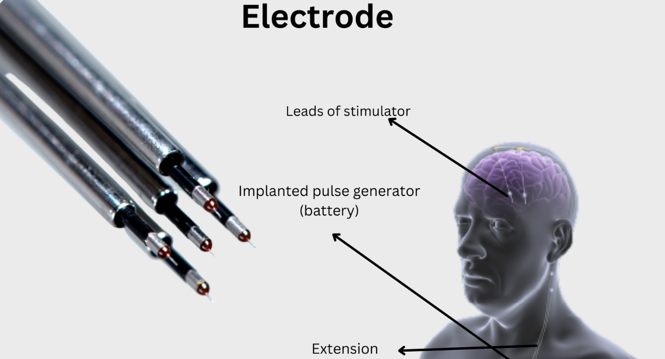 Components Of DBS System